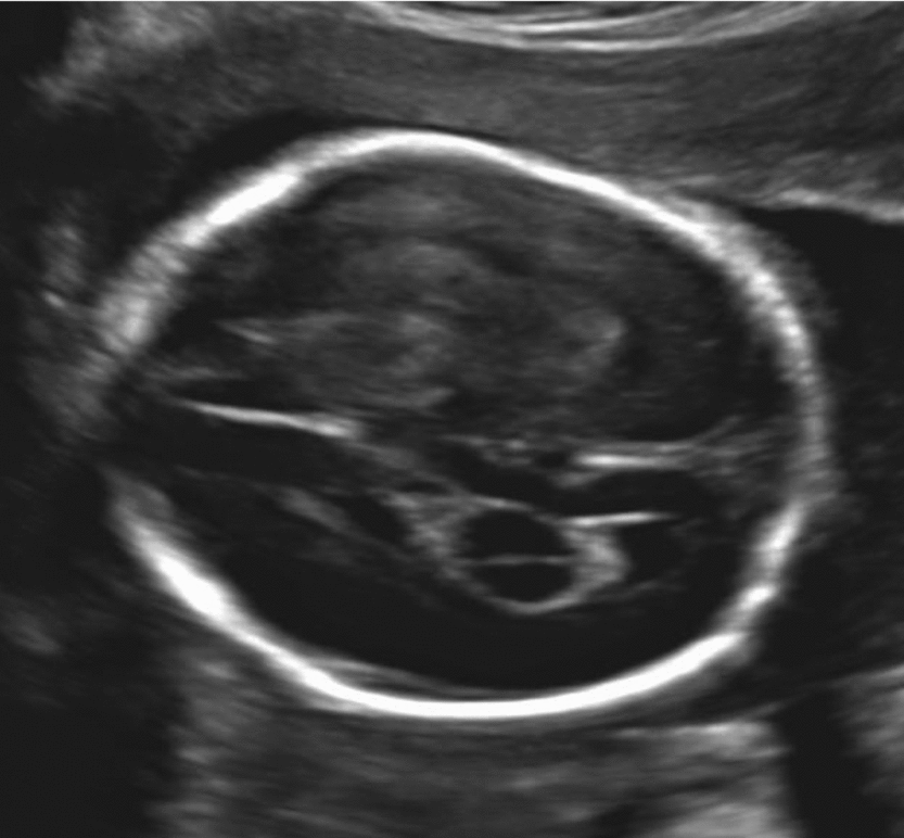 THE GENETIC SONOGRAM | Fetal and Maternal Medicine Review | Cambridge Core