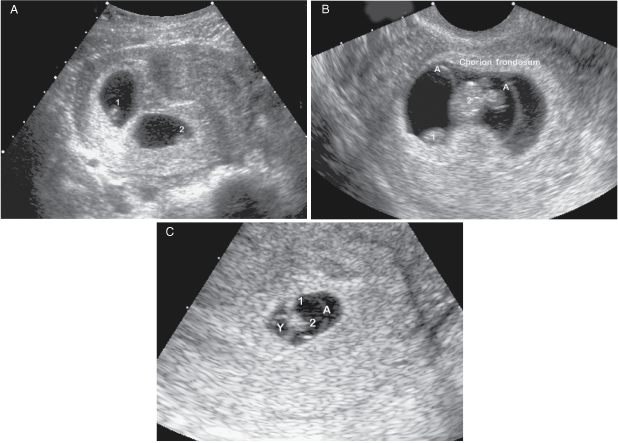 chorionic bump vanishing twin