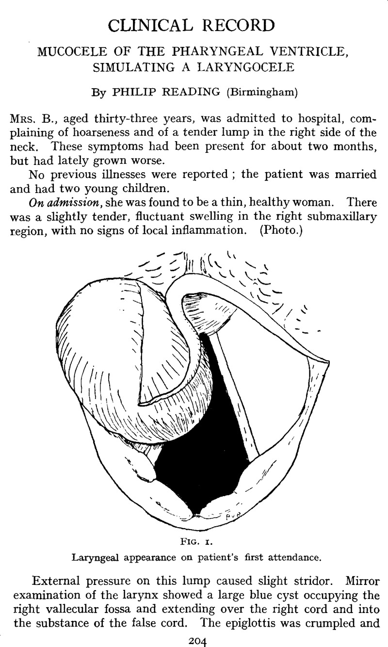 Mucocele of the Pharyngeal Ventricle, Simulating a Laryngocele | The ...