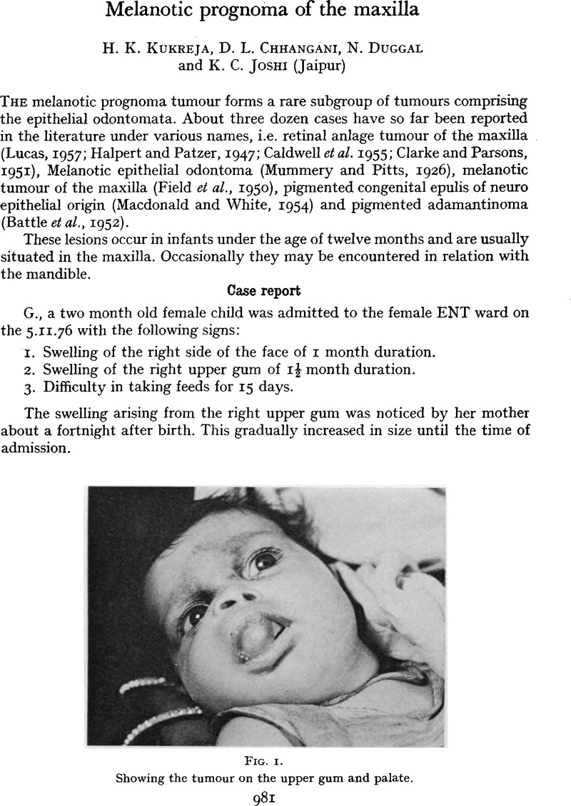 Melanotic prognoma of the maxilla | The Journal of Laryngology ...