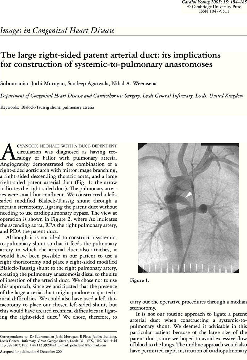 The large right-sided patent arterial duct: its implications for ...
