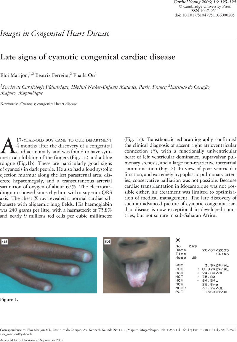 Late signs of cyanotic congenital cardiac disease | Cardiology in the ...