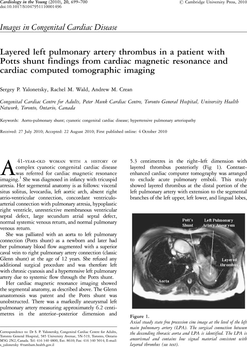 Layered left pulmonary artery thrombus in a patient with Potts shunt ...